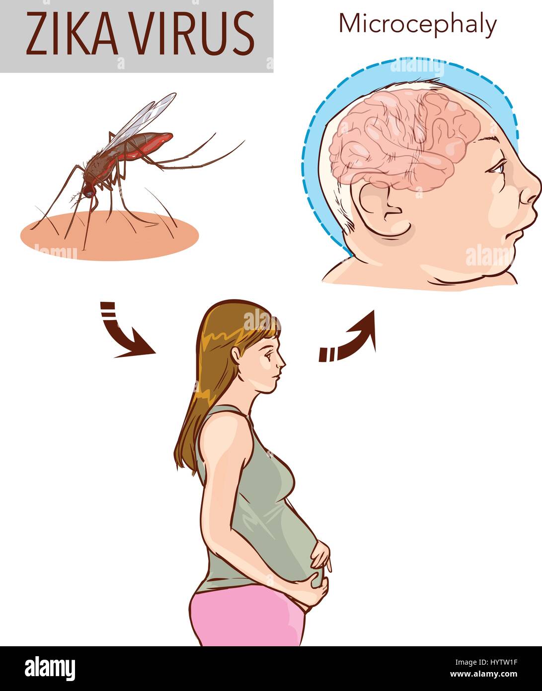 Illustration of a pregnant with Zika Virus and newborn baby with ...