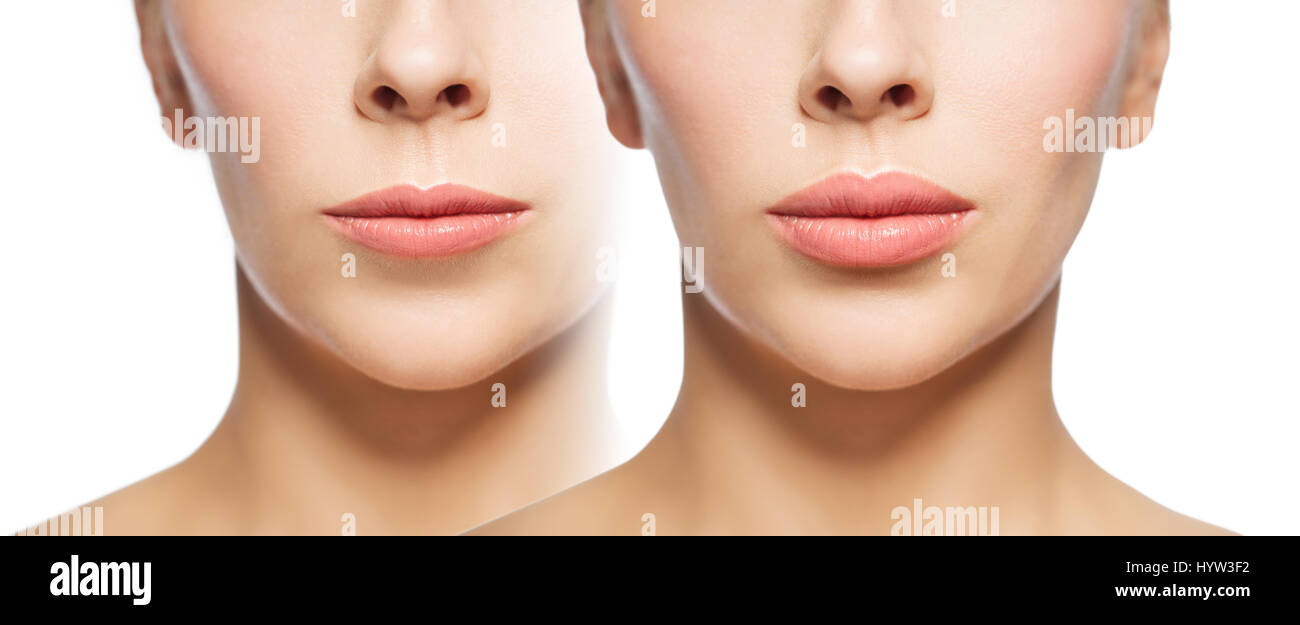woman before and after lip fillers Stock Photo - Alamy