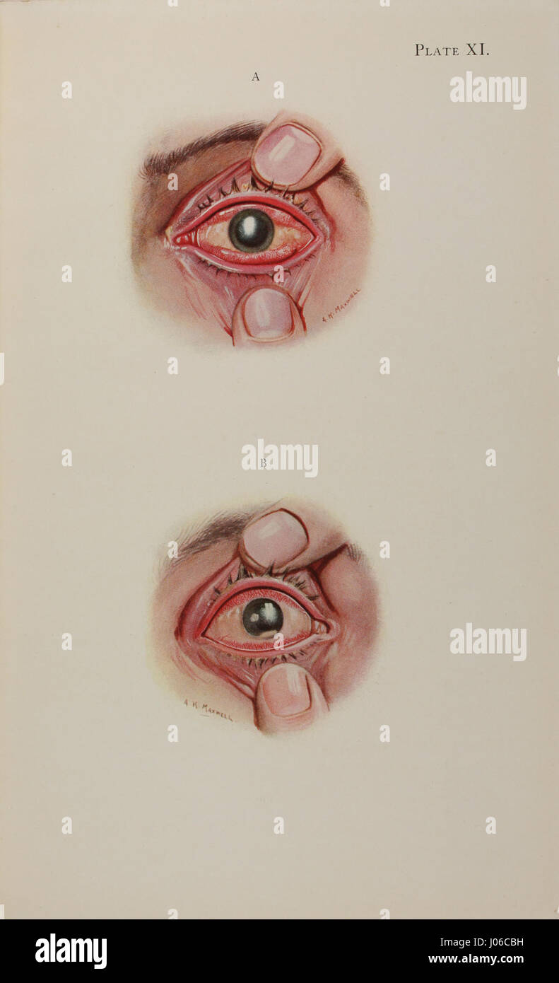 This plate from the 'An Atlas of Gas Poisoning' by the American Red ...