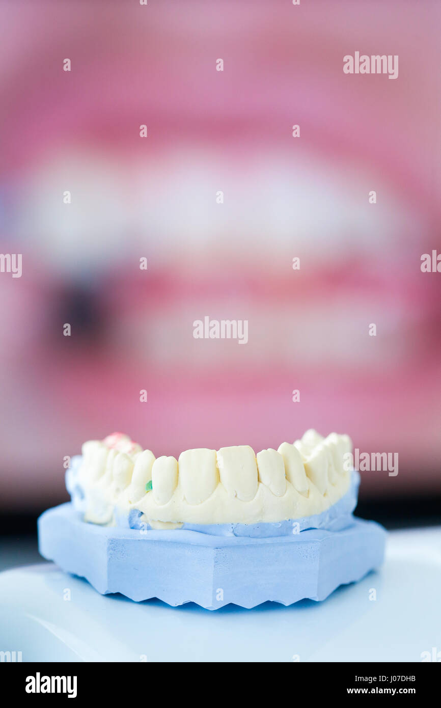 Teeth Mold Stock Photos & Teeth Mold Stock Images - Alamy