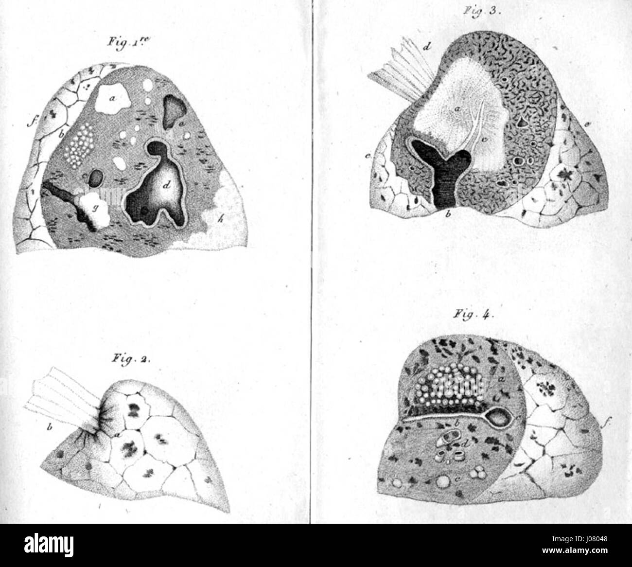 Tuberculosis drawing hi-res stock photography and images - Alamy
