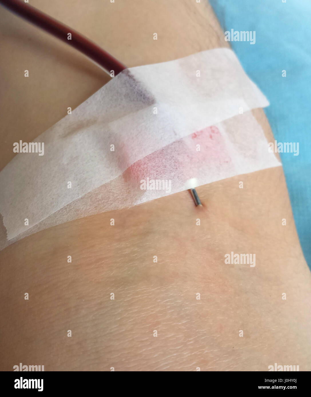 patient's arm at the hospital when donating blood with the needle in ...