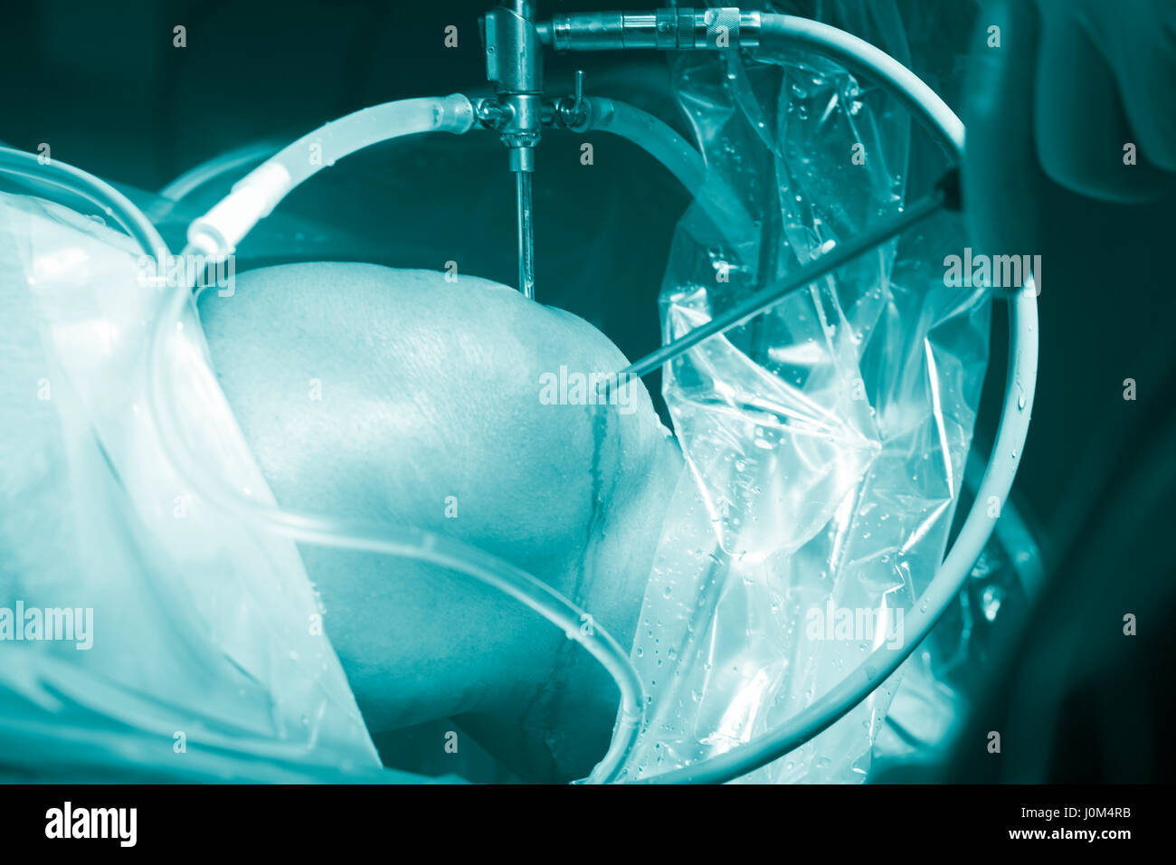 Knee keyhole surgery hospital arthroscopy operation medical procedure ...