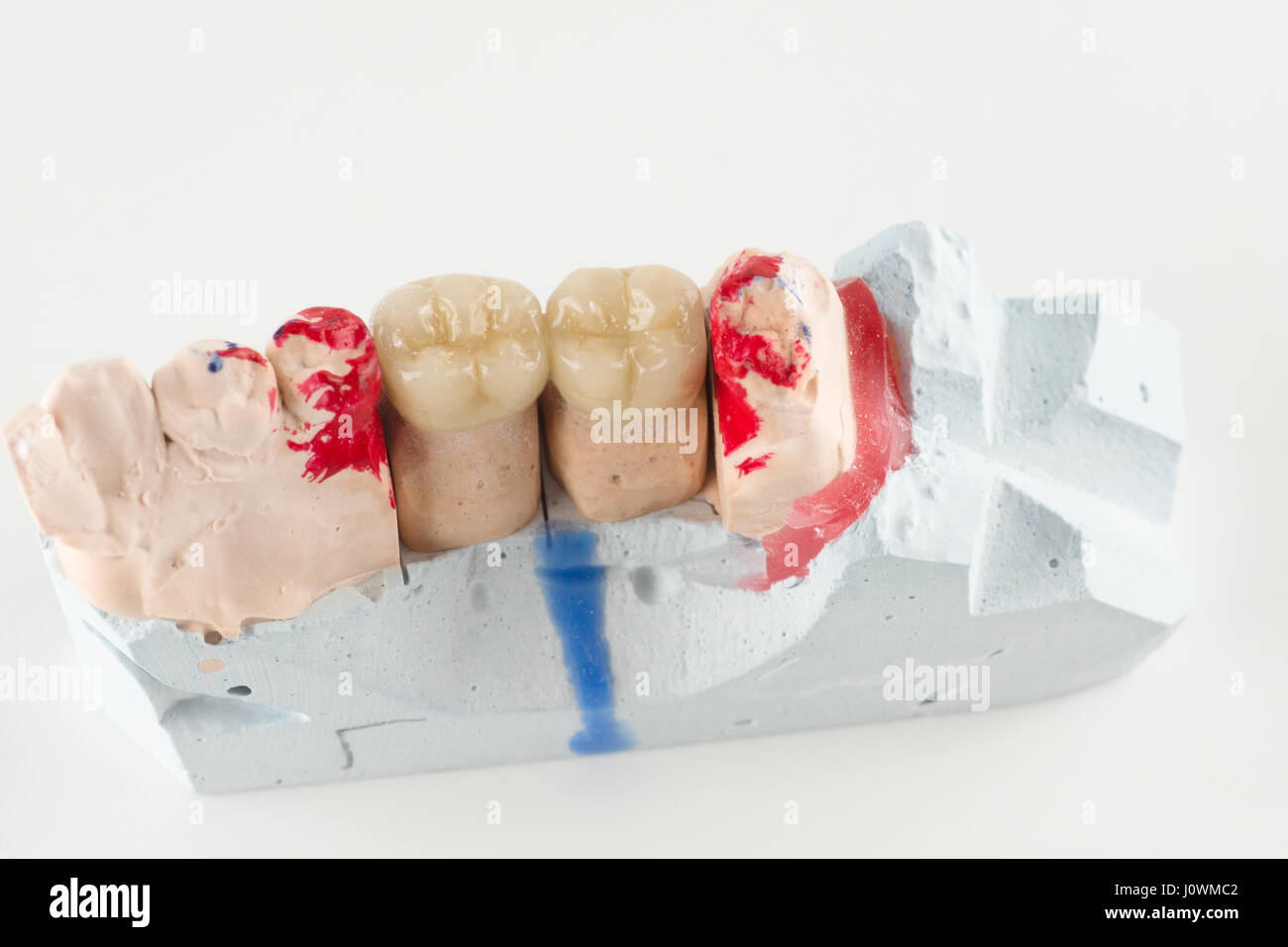 ceramic crowns to try on a tooth model for restoring decayed teeth ...
