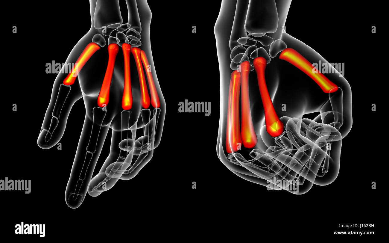 Metacarpal Bone Anatomy