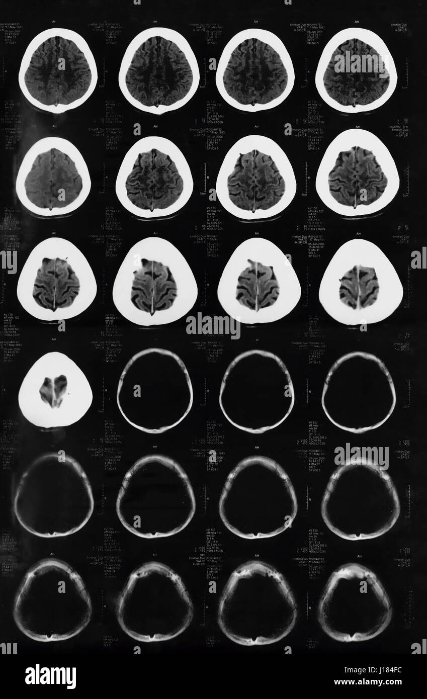 Healthy human brain xray hi-res stock photography and images - Alamy