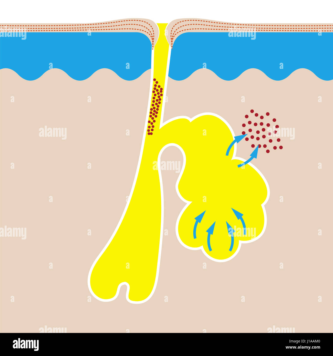 Pathogenic factors of acne inflammation process. Increased secretion of ...