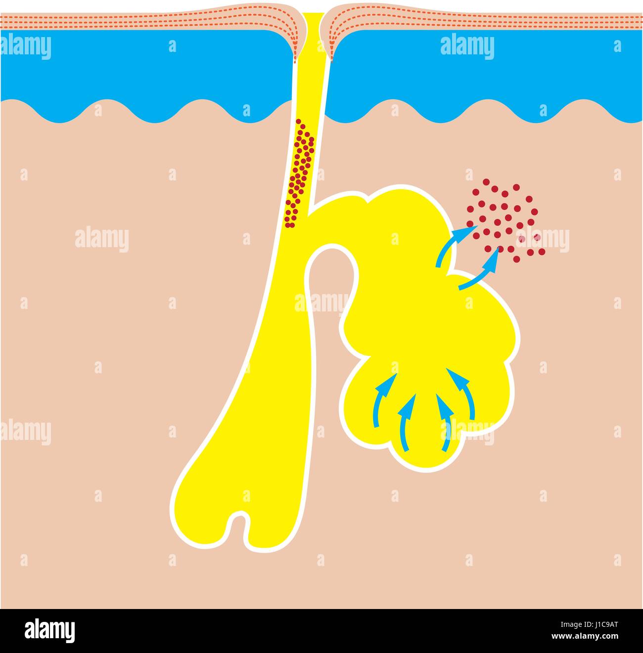 Pathogenic factors of acne inflammation process. Increased secretion of ...