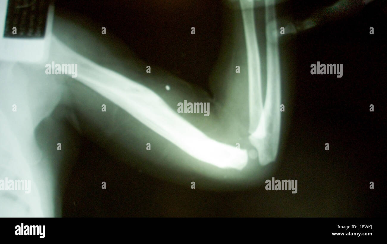 Arm fracture xray hi-res stock photography and images - Alamy