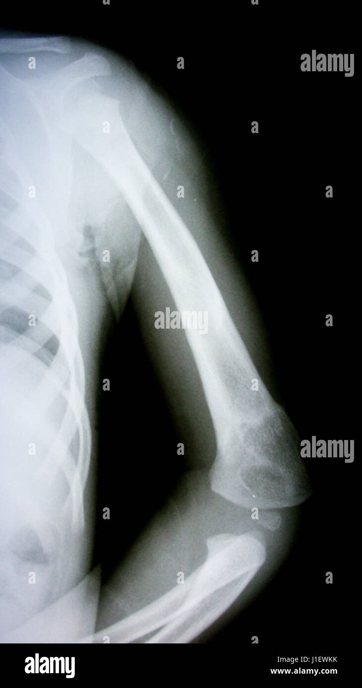 Arm fracture xray hi-res stock photography and images - Alamy