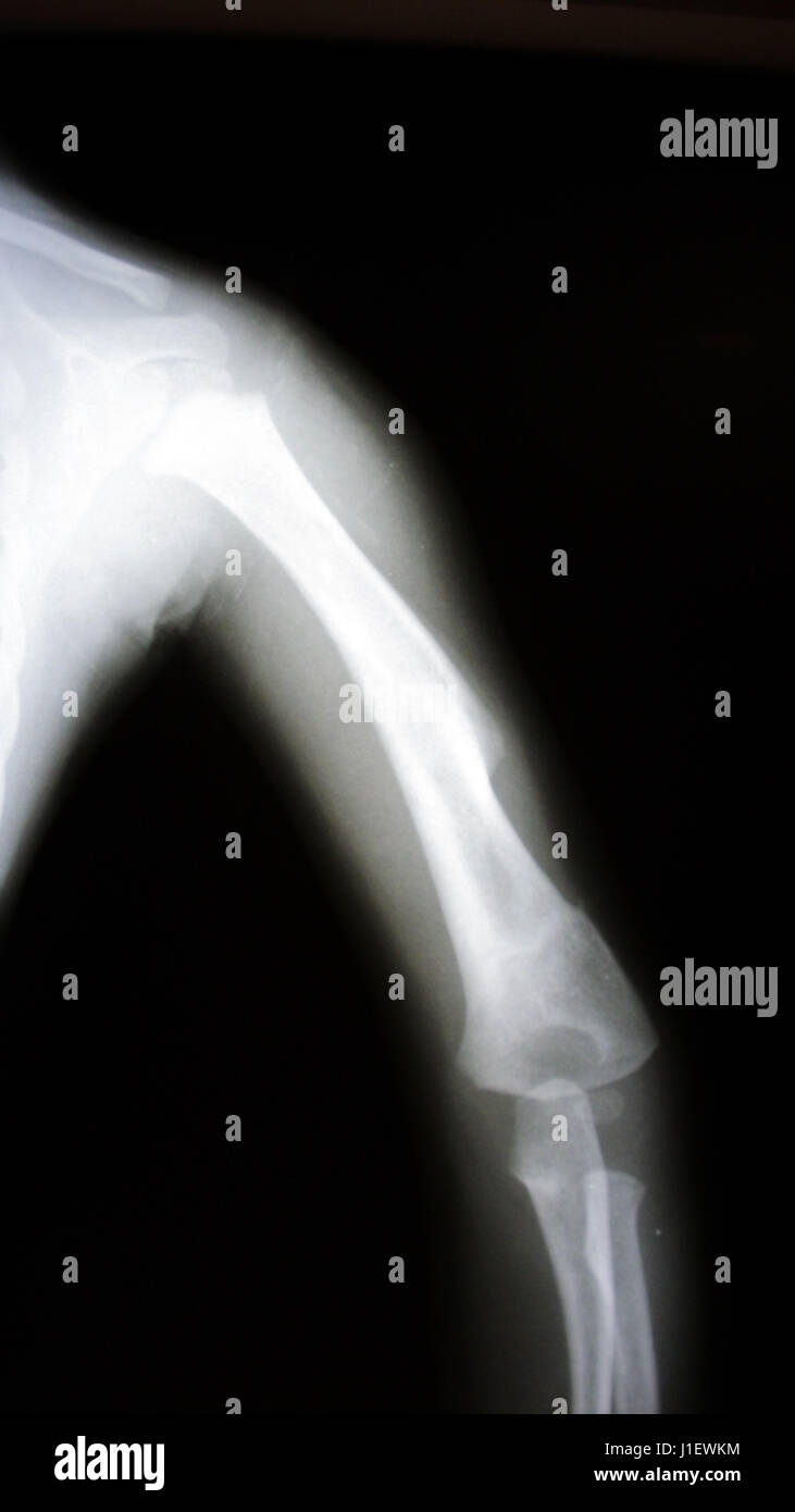Arm fracture xray hi-res stock photography and images - Alamy