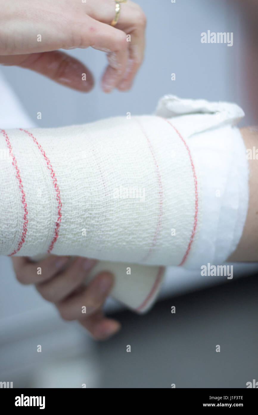 Doctor applying a plaster cast and bandages to patient forearm and ...