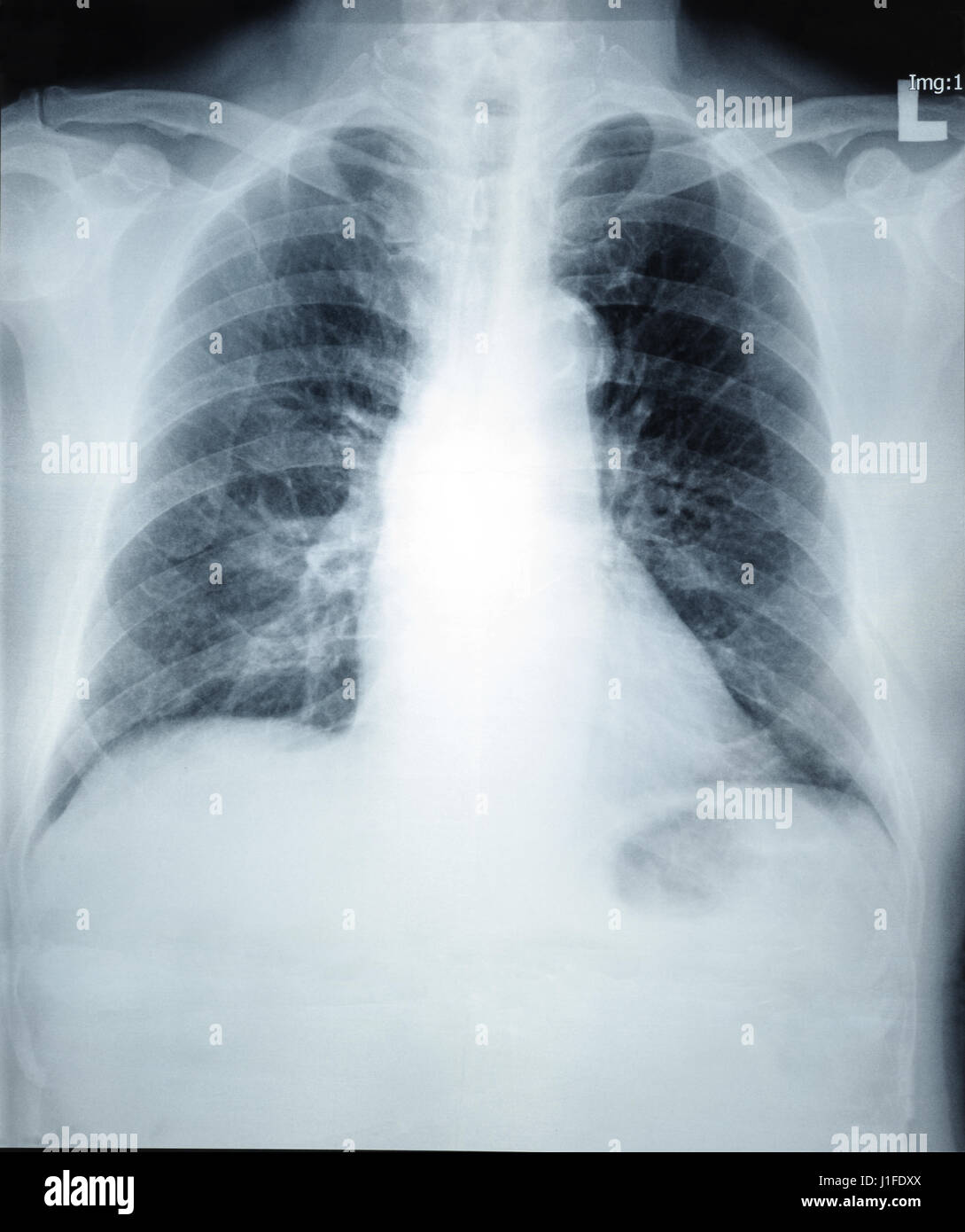 Chest radiograph hi-res stock photography and images - Alamy
