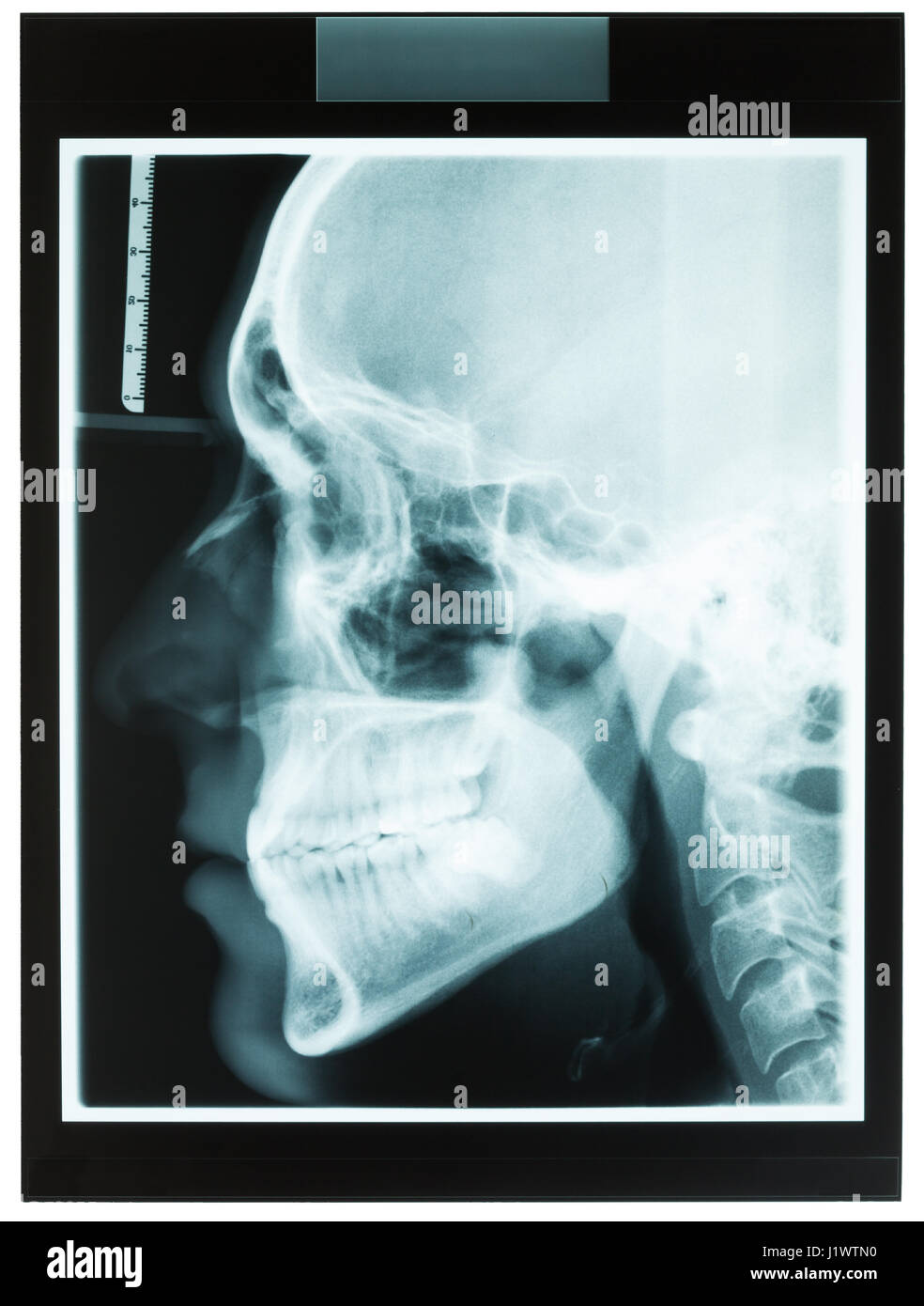 Profile xray of man's jaw with tooth close-up for dental orthodontic ...