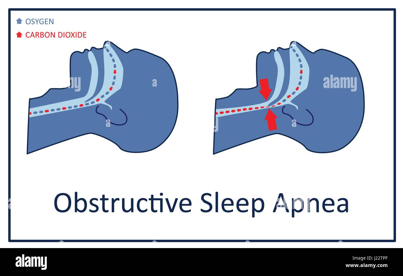 Vector Illustration Of Obstructive Sleep Apnea Stock Vector Image And Art