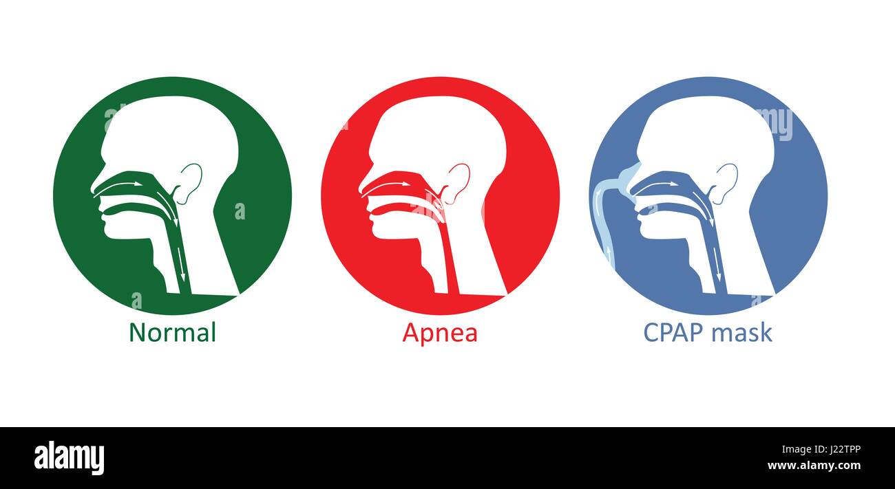 Vector illustration of normal breathing, with apnea disease and with ...