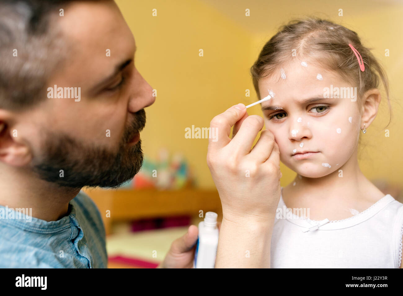 Chickenpox hi-res stock photography and images - Alamy