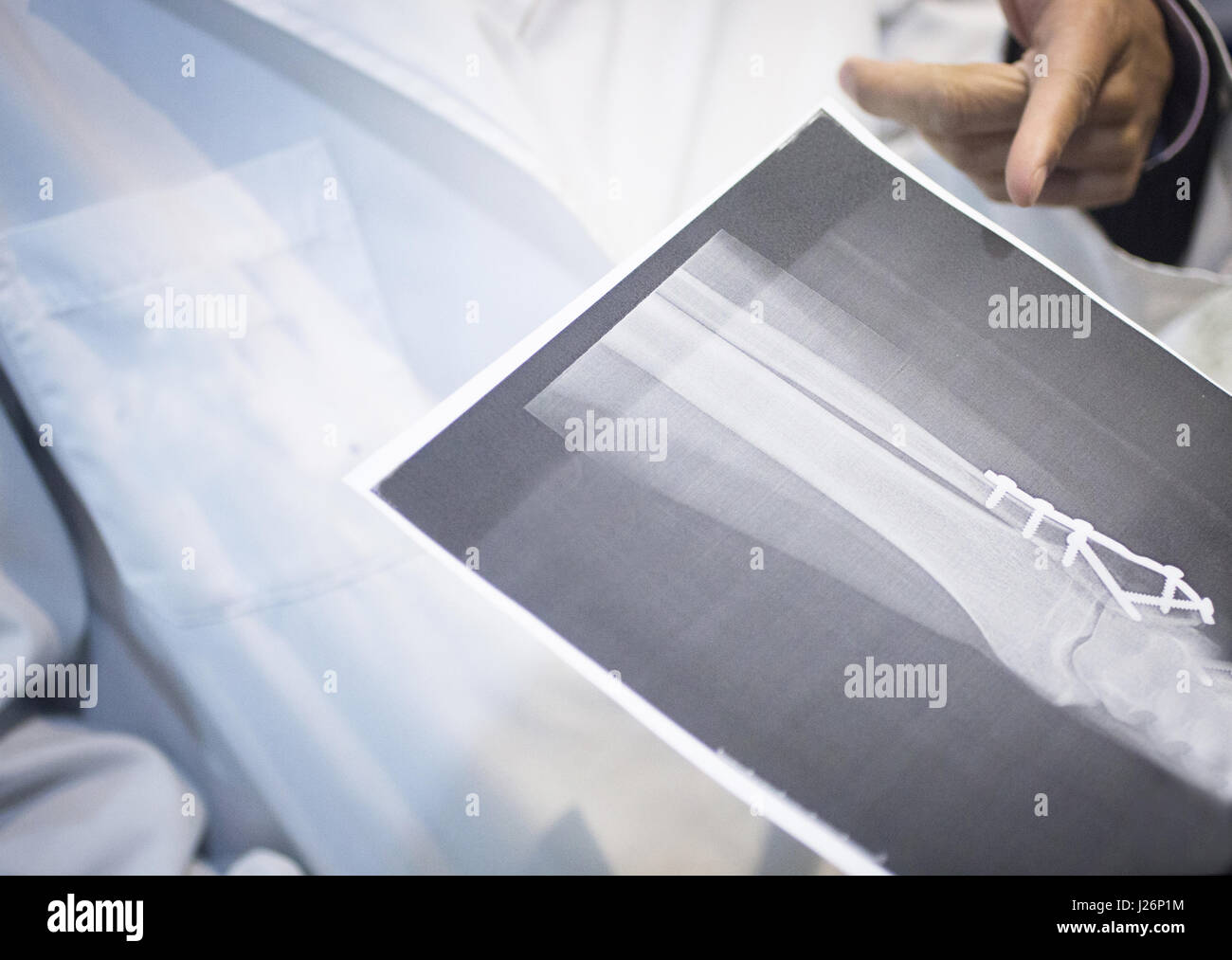 Orthopedics x-ray knee plate and screw prosthetic implant test results ...