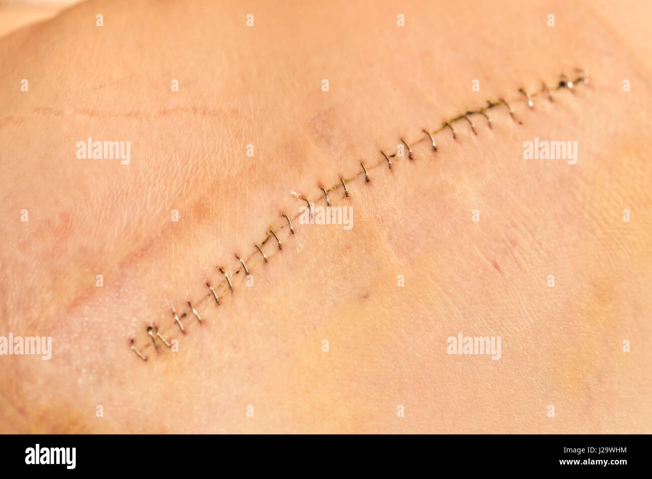 Long scar with staples fasteners and clamp on leg Stock Photo - Alamy
