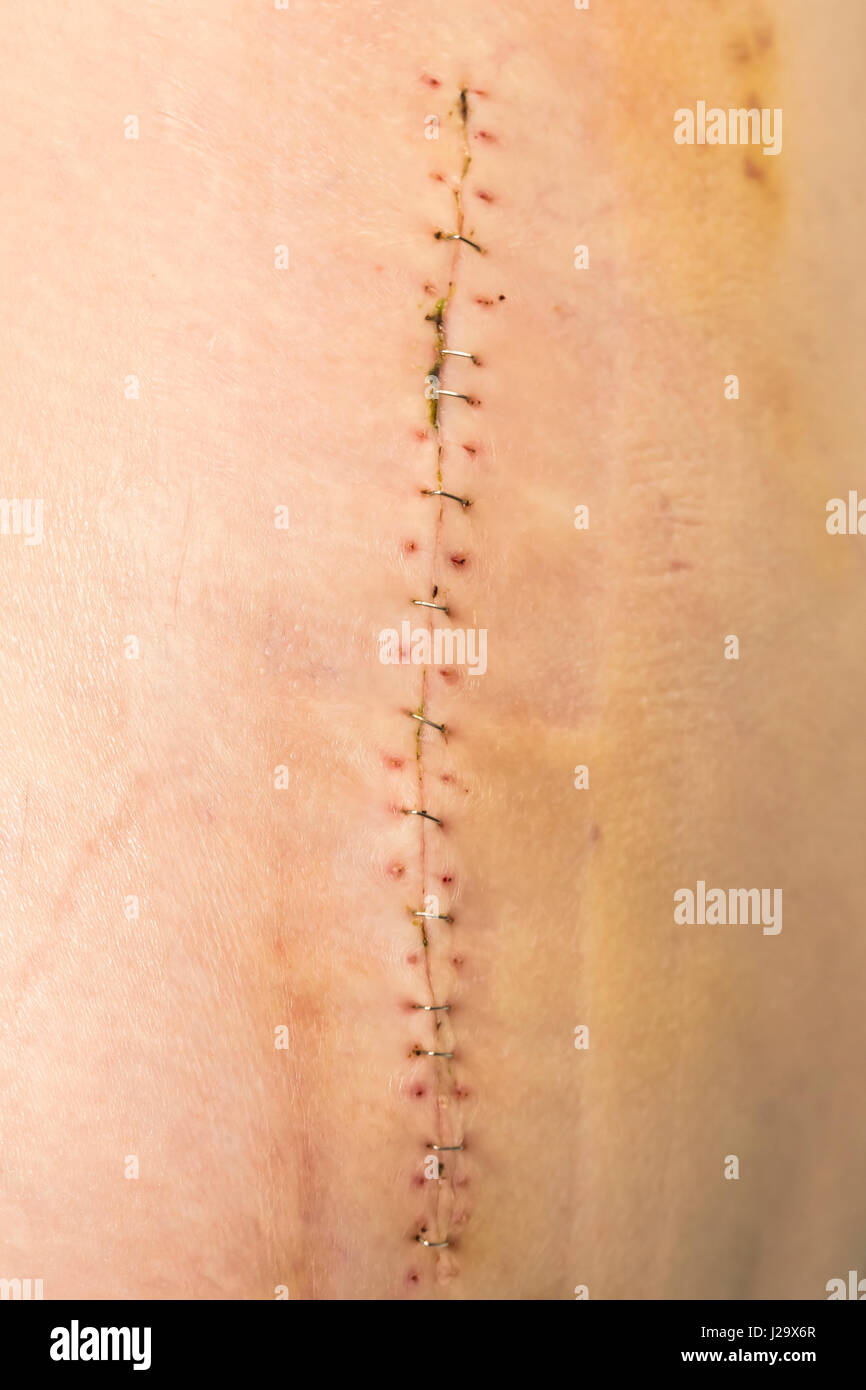 Long scar with staples fasteners and clamp on leg Stock Photo - Alamy