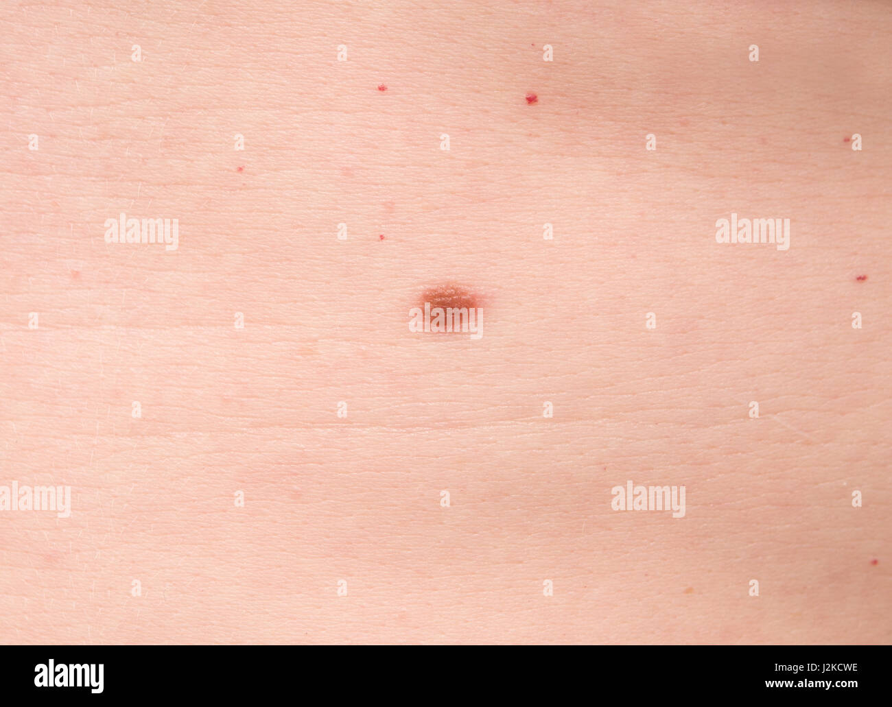 Hairy mole hi-res stock photography and images - Alamy
