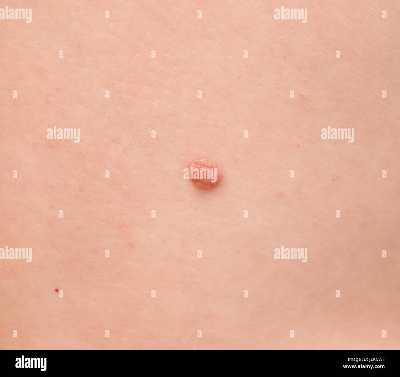 Hairy mole hi-res stock photography and images - Alamy