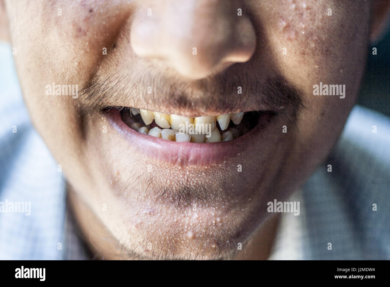 Dirty Teeth High Resolution Stock Photography and Images - Alamy