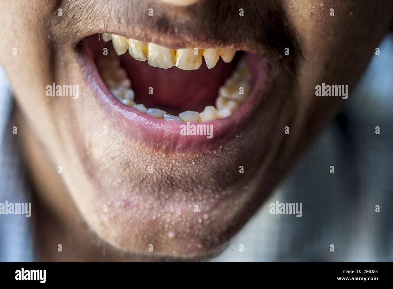Dirty teeth hi-res stock photography and images - Alamy