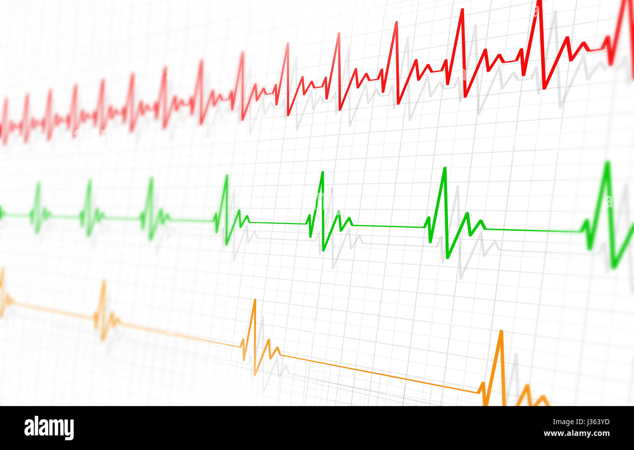 medicine illustration of different heart pulsatings fast normal and ...
