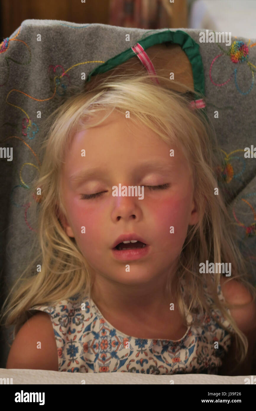 Erythema solar hi-res stock photography and images - Alamy