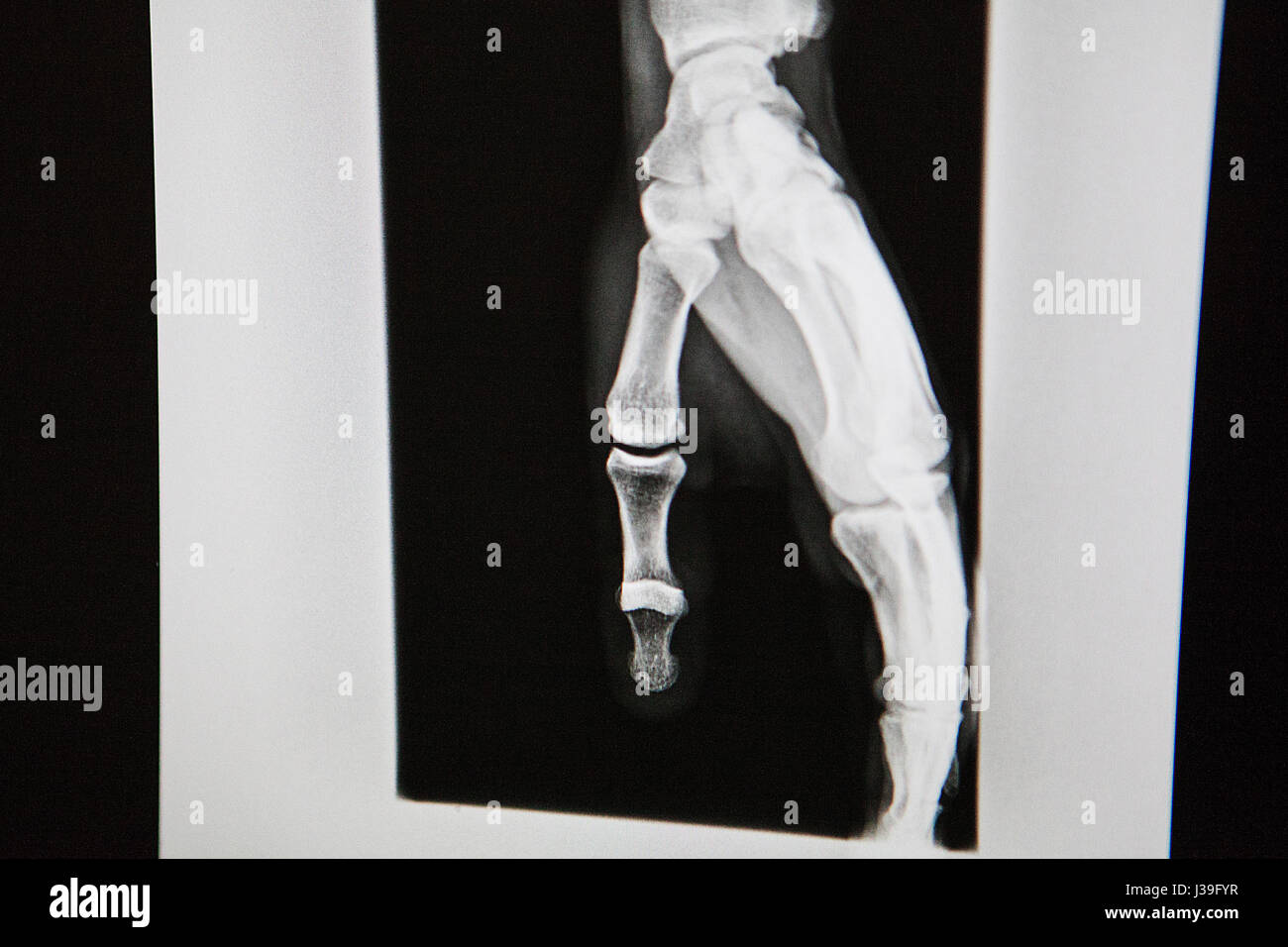 Thumb dislocation hi-res stock photography and images - Alamy