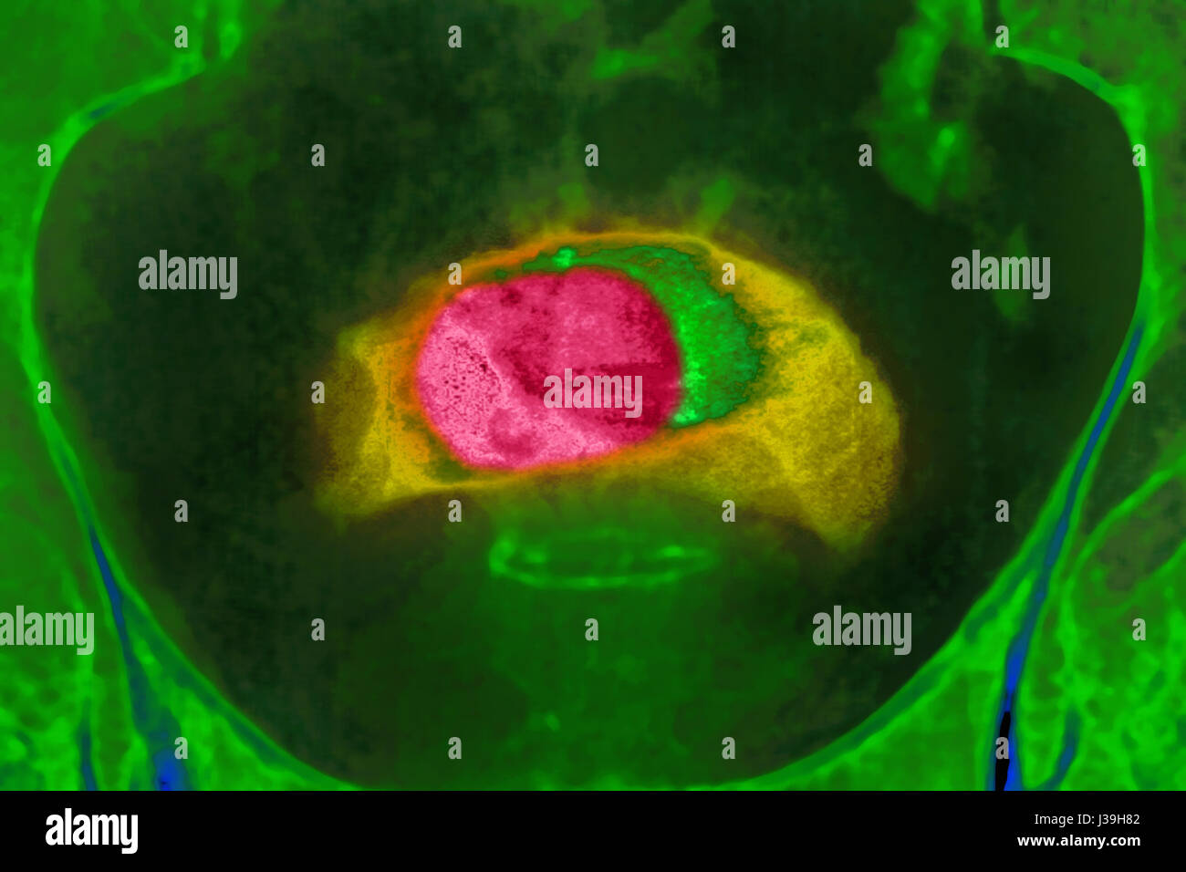 PROSTATIC ADENOMA, X-RAY Stock Photo - Alamy