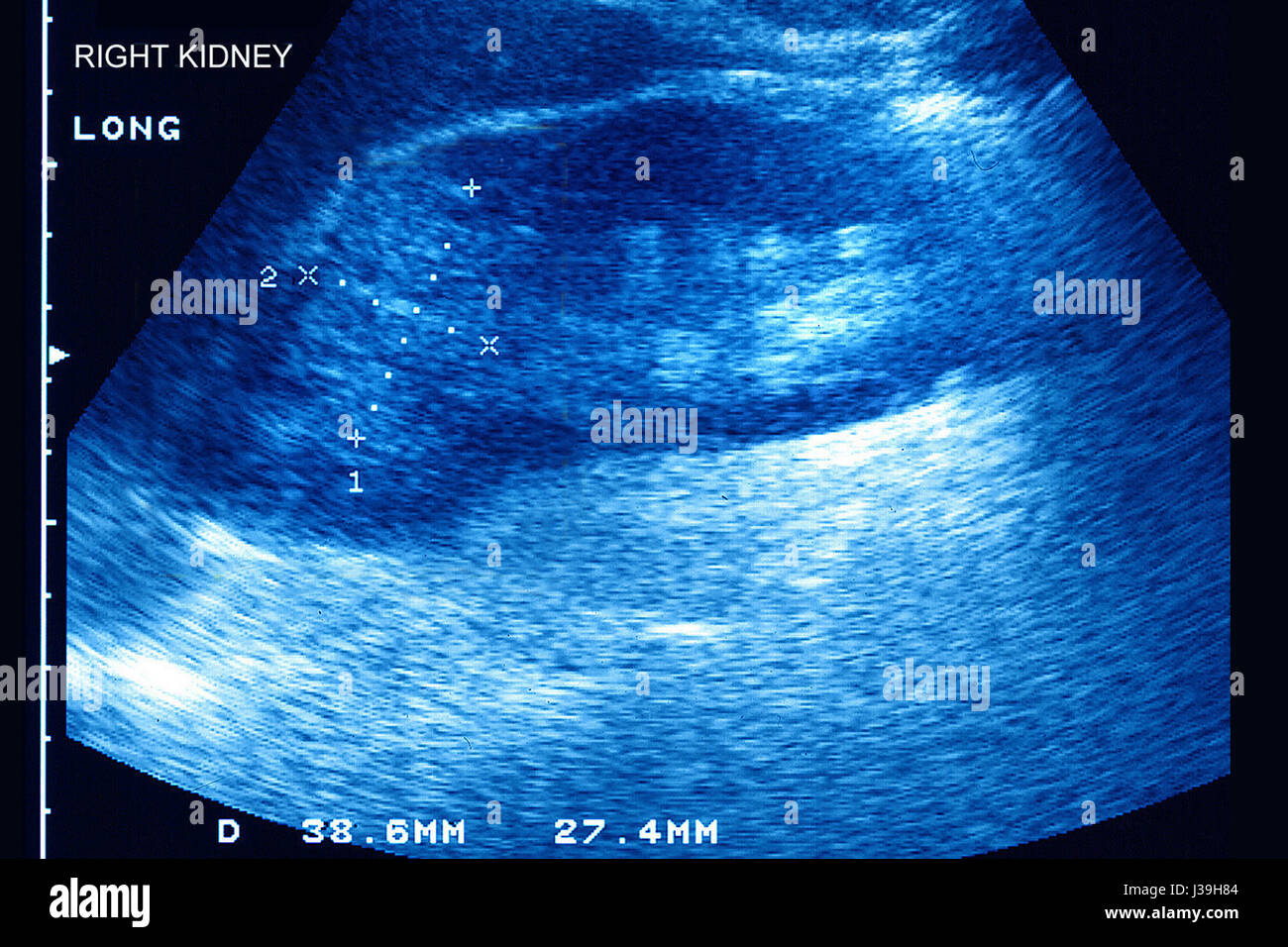 KIDNEY CANCER, SONOGRAPHY Stock Photo - Alamy