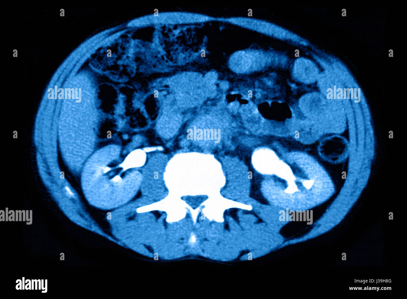 NEPHRITIC COLIC, SCAN Stock Photo - Alamy