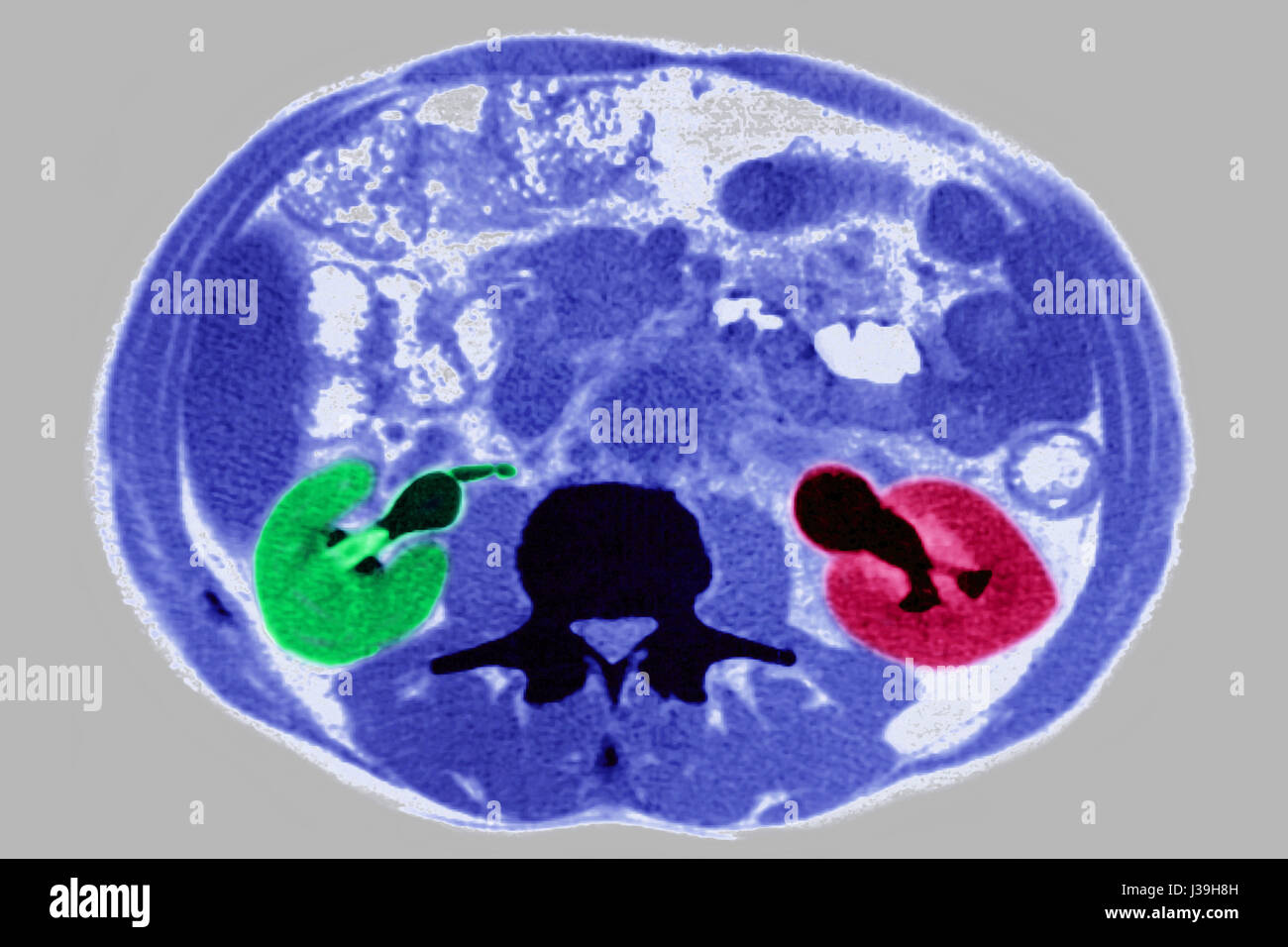 NEPHRITIC COLIC, SCAN Stock Photo - Alamy