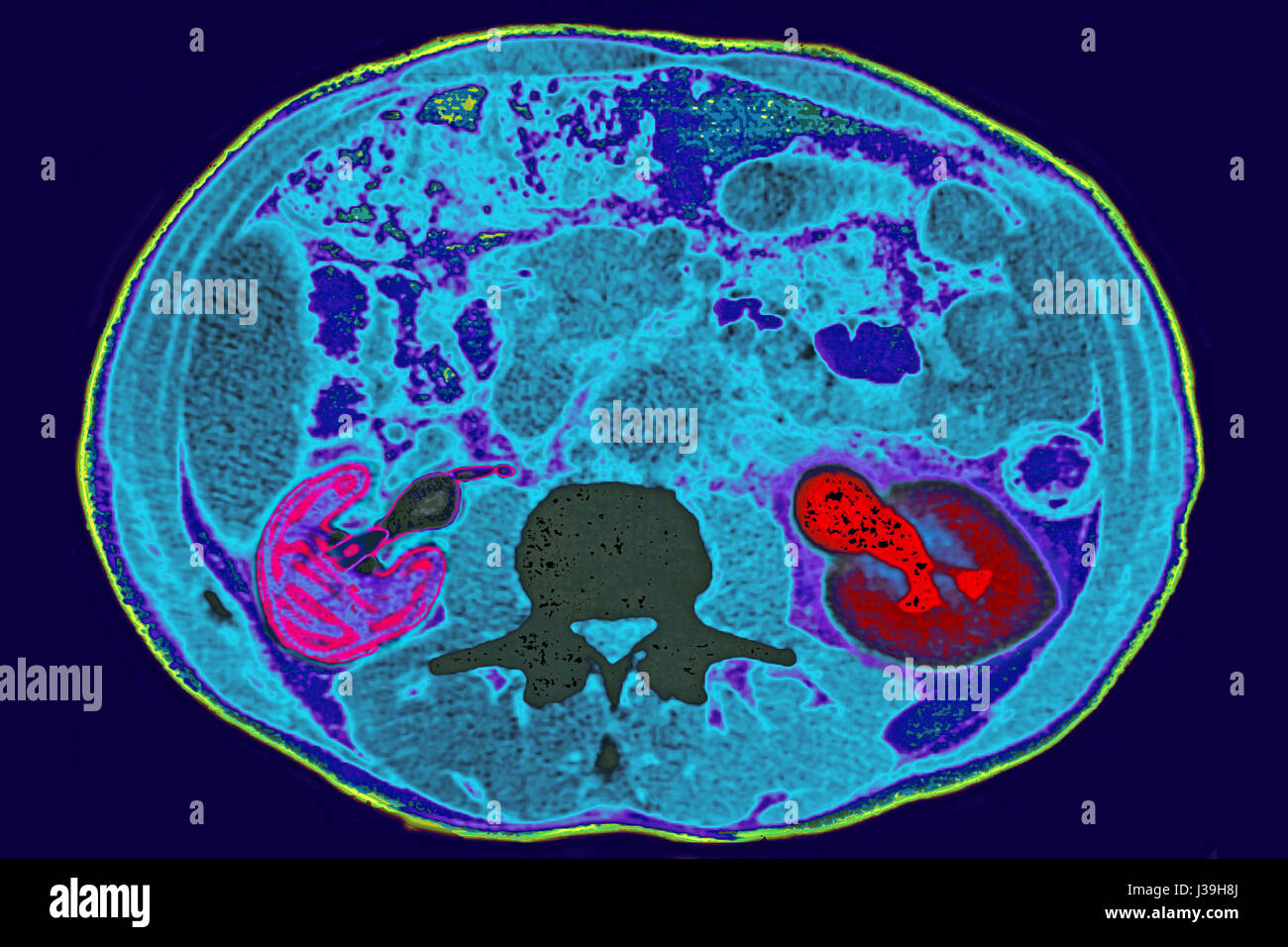 NEPHRITIC COLIC, SCAN Stock Photo - Alamy