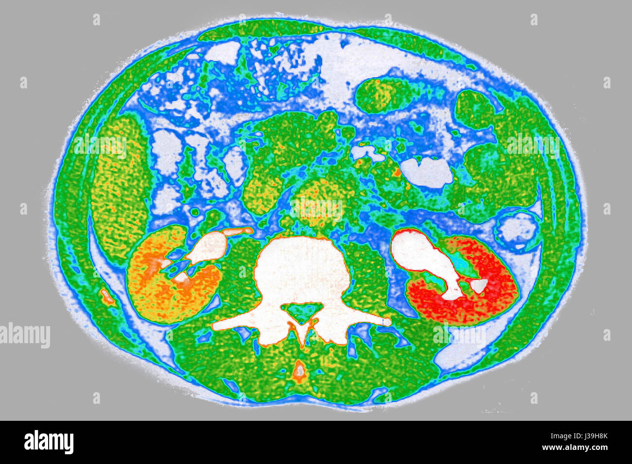 NEPHRITIC COLIC, SCAN Stock Photo - Alamy