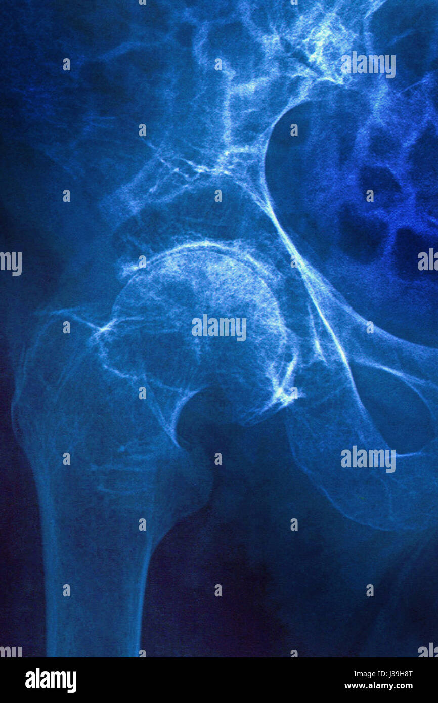 FRACTURED HIP, X-RAY Stock Photo - Alamy