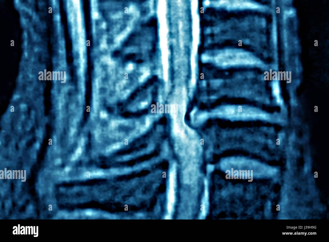 Herniated disc mri hi-res stock photography and images - Alamy