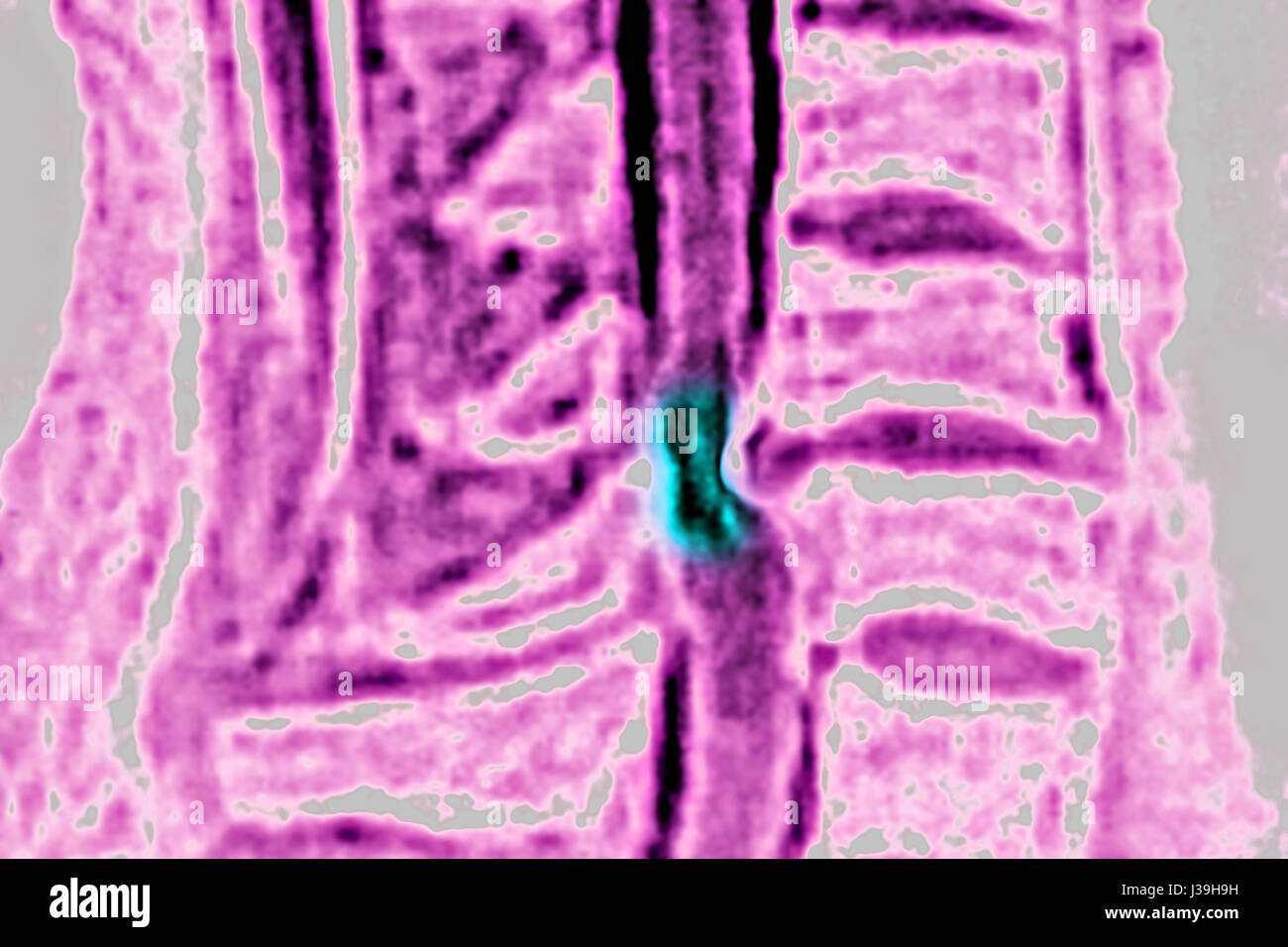 HERNIATED DISK, MRI Stock Photo - Alamy