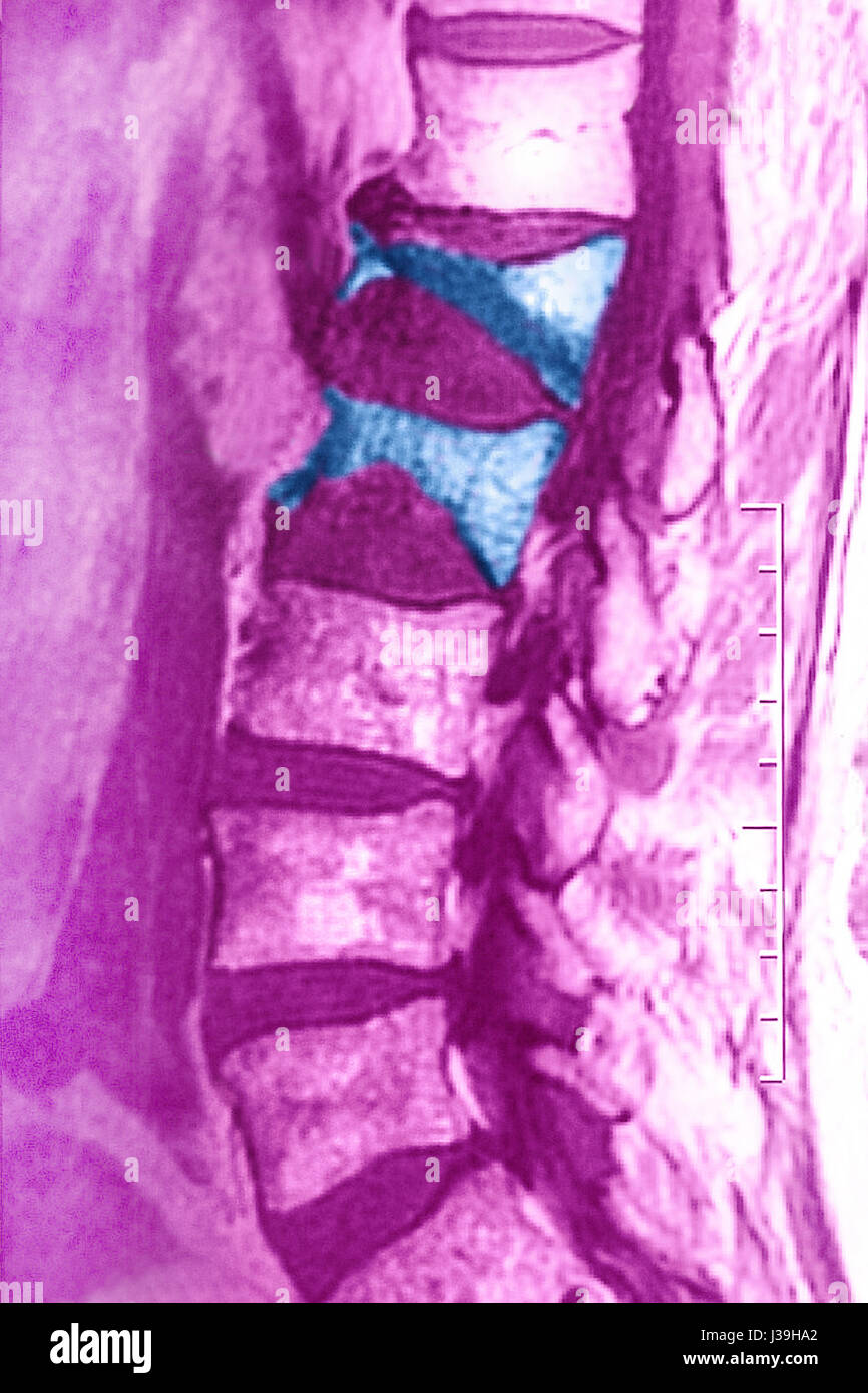 Compression fracture hi-res stock photography and images - Alamy