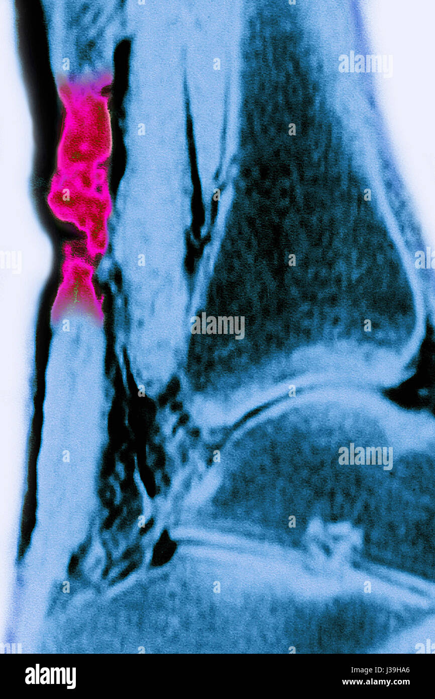 RUPTURED TENDON, MRI Stock Photo - Alamy