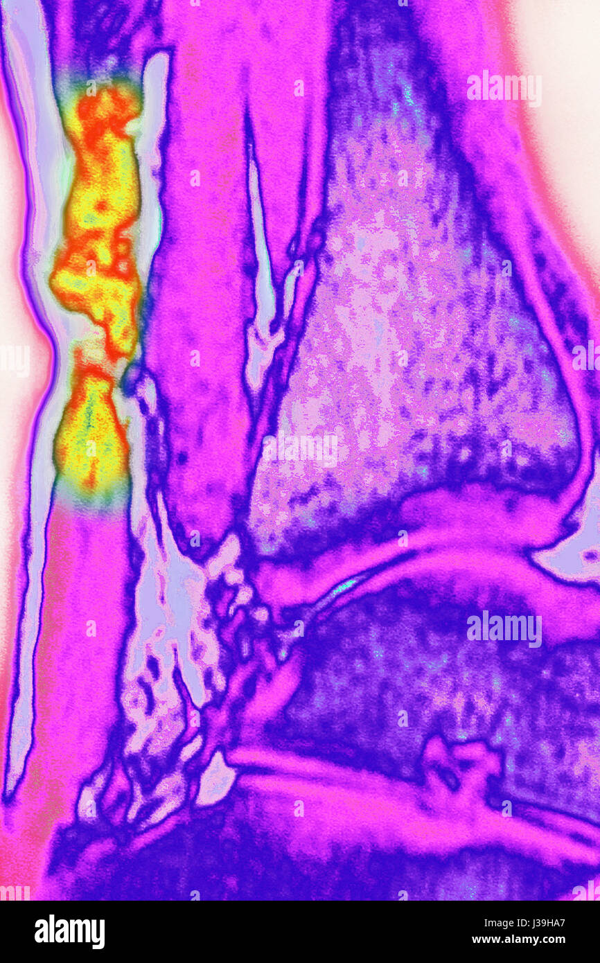 RUPTURED TENDON, MRI Stock Photo - Alamy