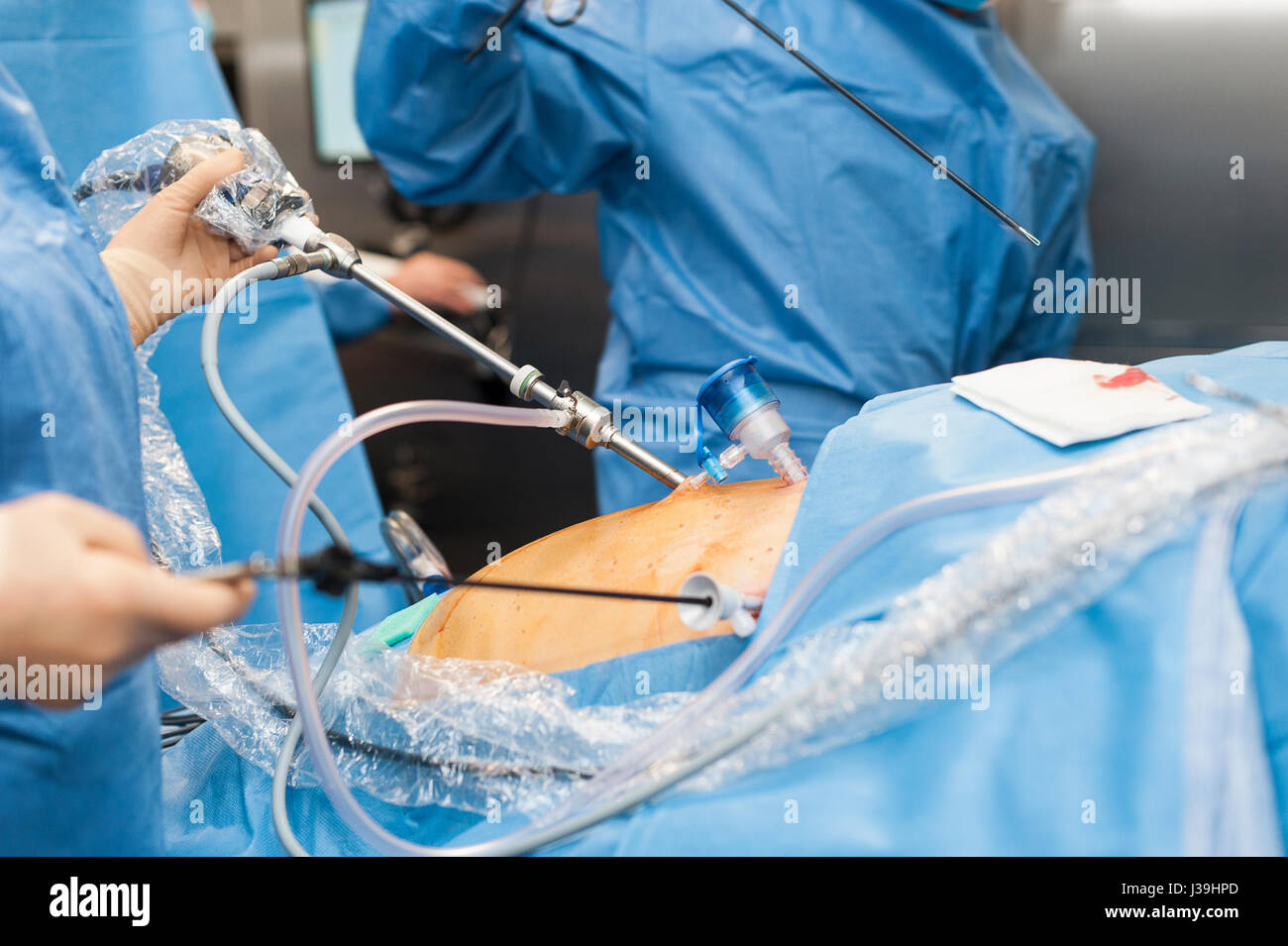 Gynecological operations hi-res stock photography and images - Alamy