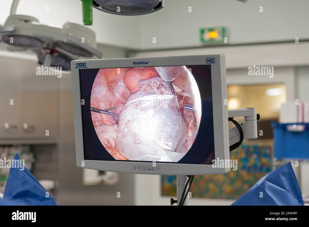 Gynecological operations hi-res stock photography and images - Alamy