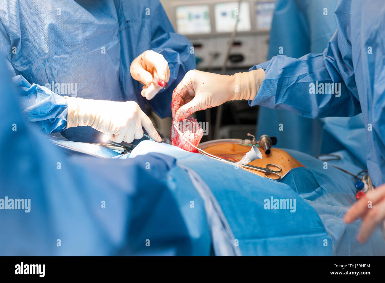 Gynecological operations hi-res stock photography and images - Alamy