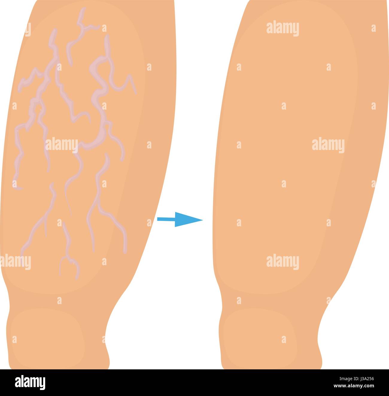 Varicose veins operation icon, cartoon style Stock Vector Image & Art ...