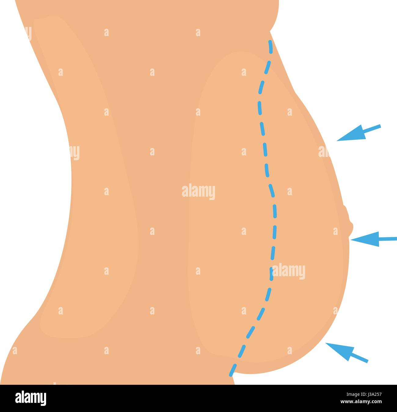 Woman body correction liposuction Stock Vector Images - Alamy