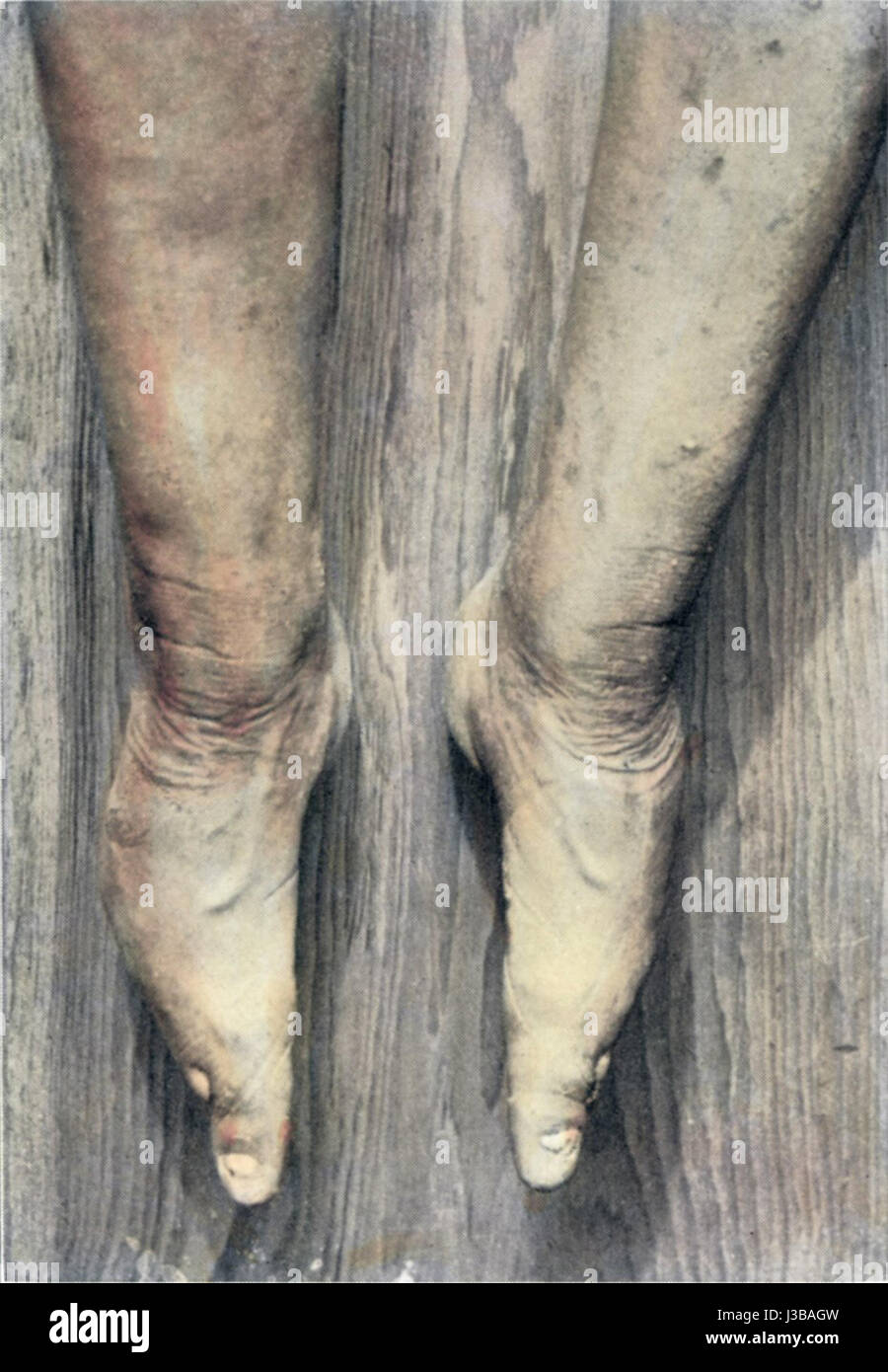An image depicting deformed feet of a Chinese woman, illustrating the ...