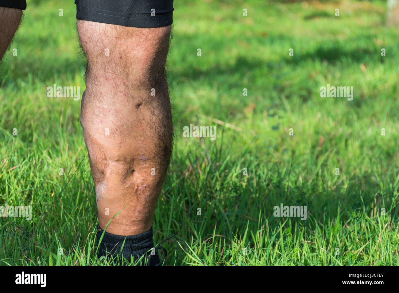 Old scar leg injury from hi-res stock photography and images - Alamy